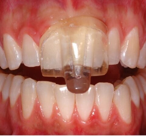 Teeth Grinding Splints Croydon | Divine Dental Care VIC 3136